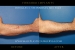 Forearm Implants in LA - Male Plastic Surgery Los Angeles