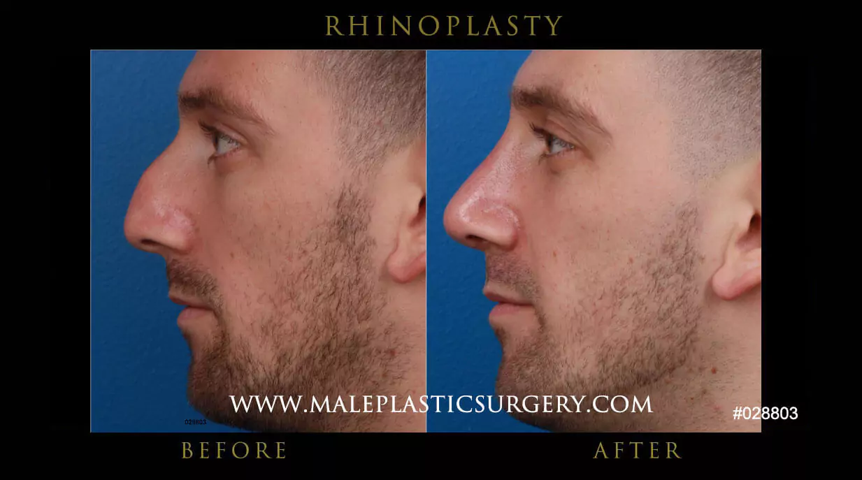 Rhinoplasty Surgery - Male Plastic Surgery Los Angeles
